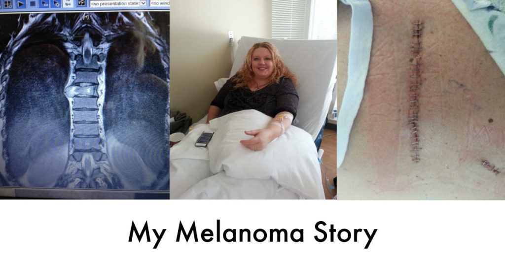 My Melanoma Story Spreading Awareness During Skin Cancer Awareness Month